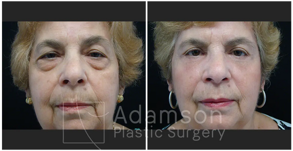 Surgery Of the Eyelid Cases - Adamson Plastic Surgery