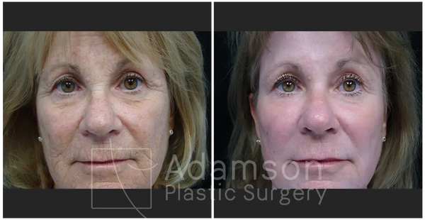Treatment Of the Skin Cases - Adamson Plastic Surgery